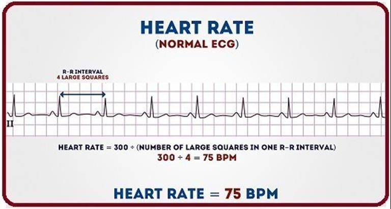 Electrocardiogram(ECG): Definition, Test, Signal Read & Diagnose - The ...